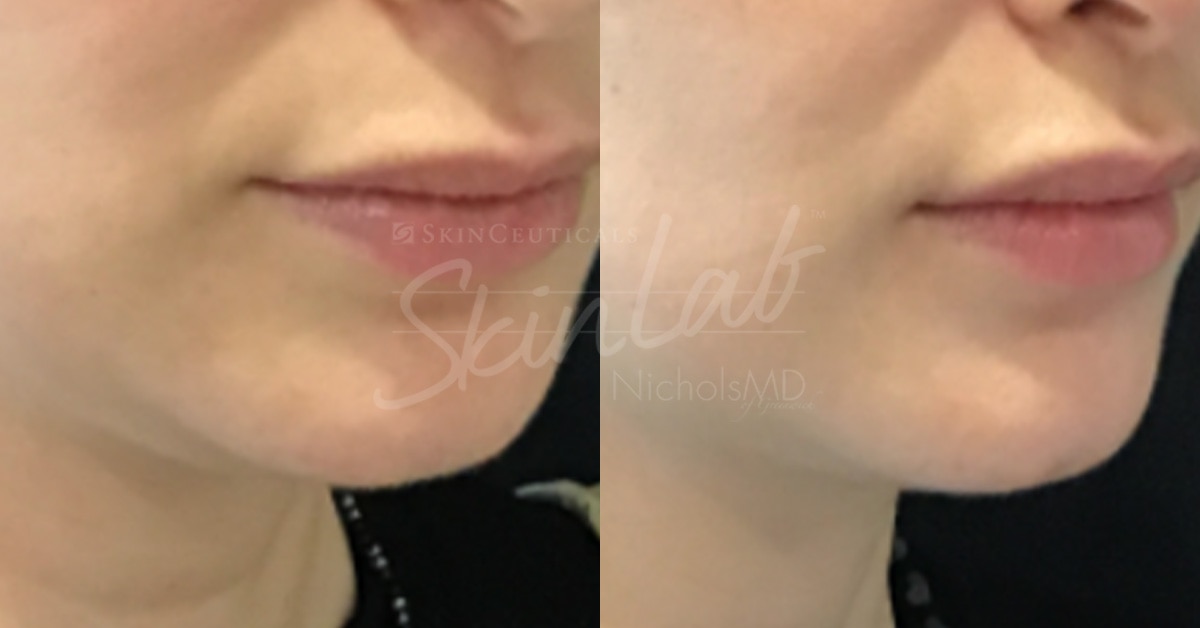 Before & After - Procedure Photos | SkinLab