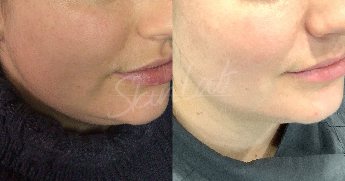 Before & After - Procedure Photos | SkinLab