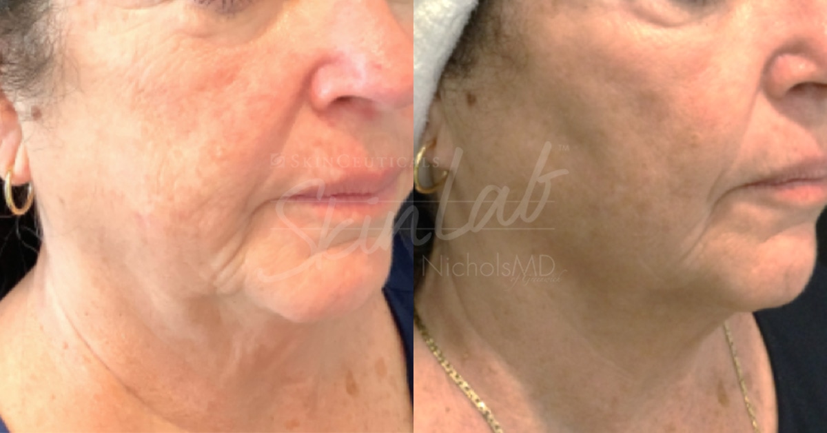 Before & After - Procedure Photos | SkinLab