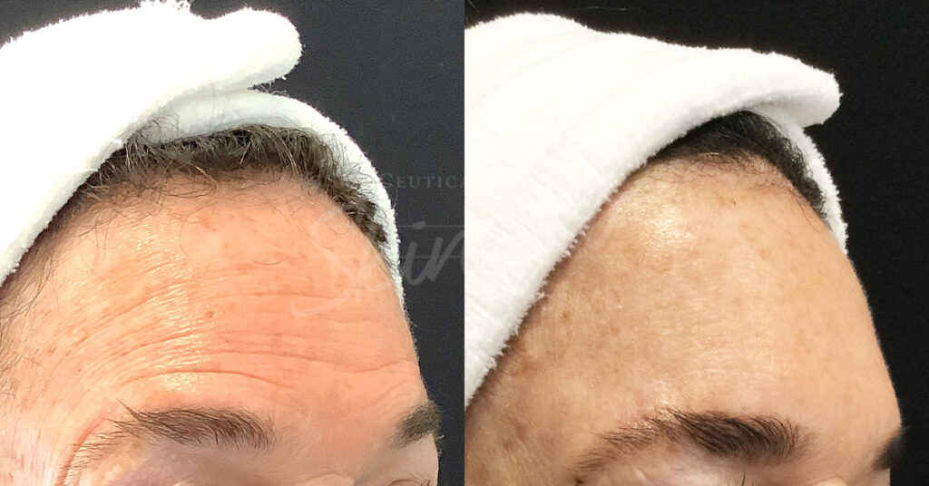 Before & After - Procedure Photos | SkinLab