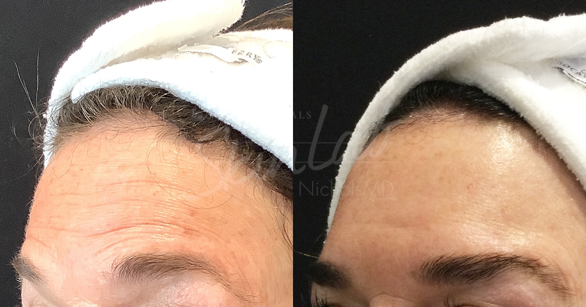Before & After - Procedure Photos | SkinLab