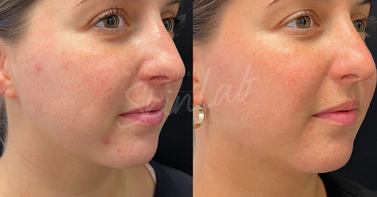Before & After - Procedure Photos | SkinLab