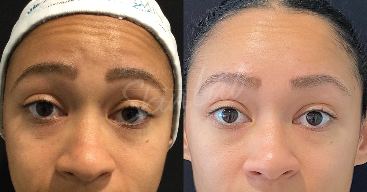 Before & After - Procedure Photos | SkinLab