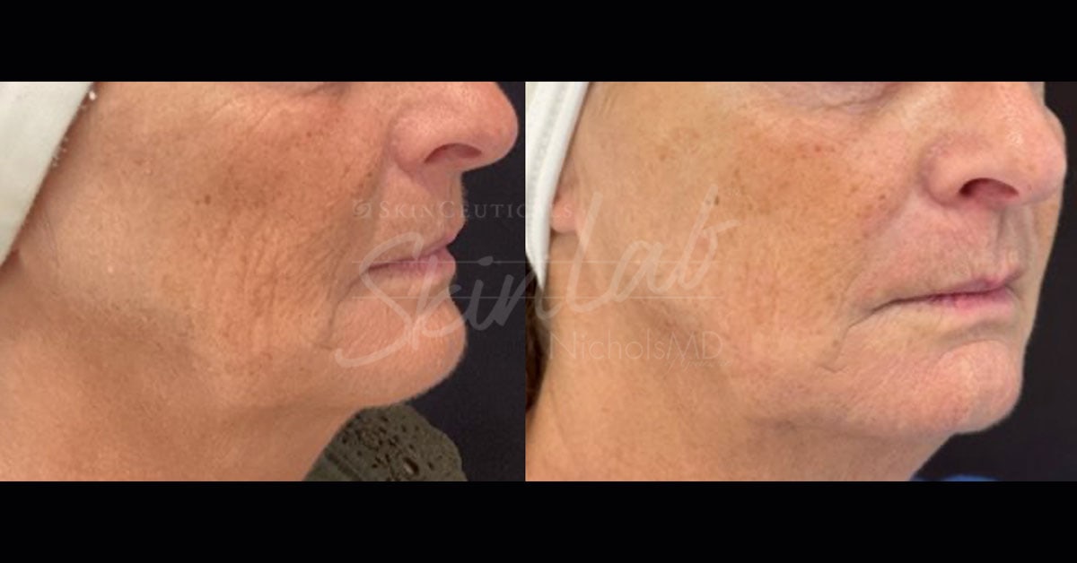 Before & After - Procedure Photos | SkinLab