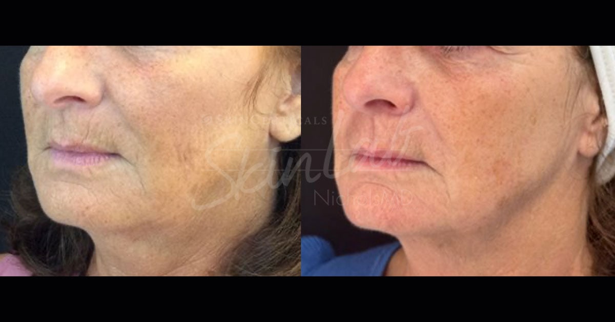 Before & After - Procedure Photos | SkinLab