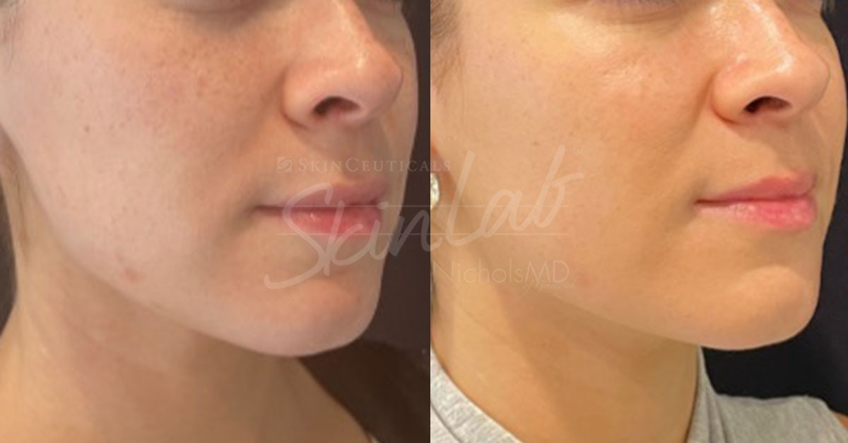 Before & After - Procedure Photos | SkinLab