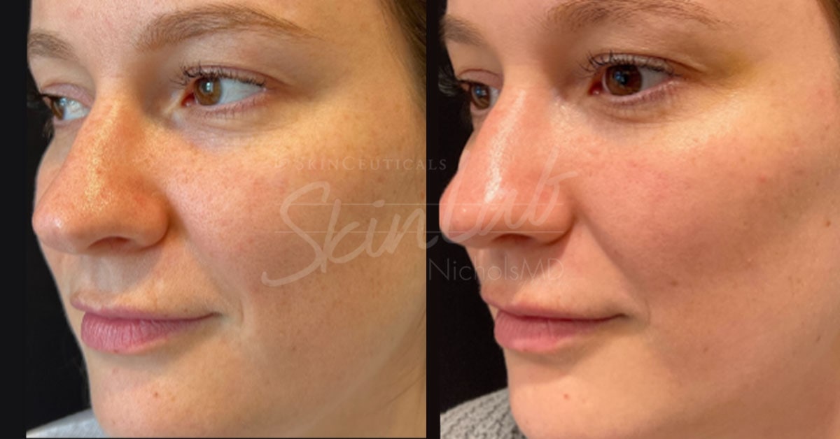 Before & After - Procedure Photos | SkinLab