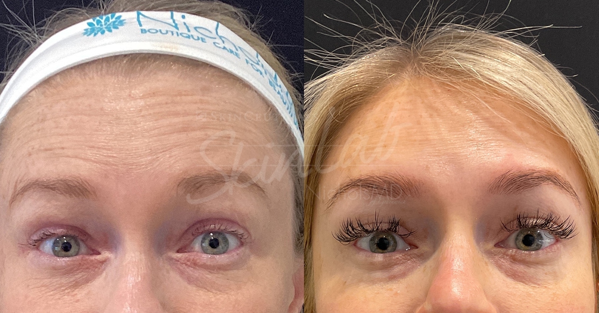 Before & After - Procedure Photos | SkinLab