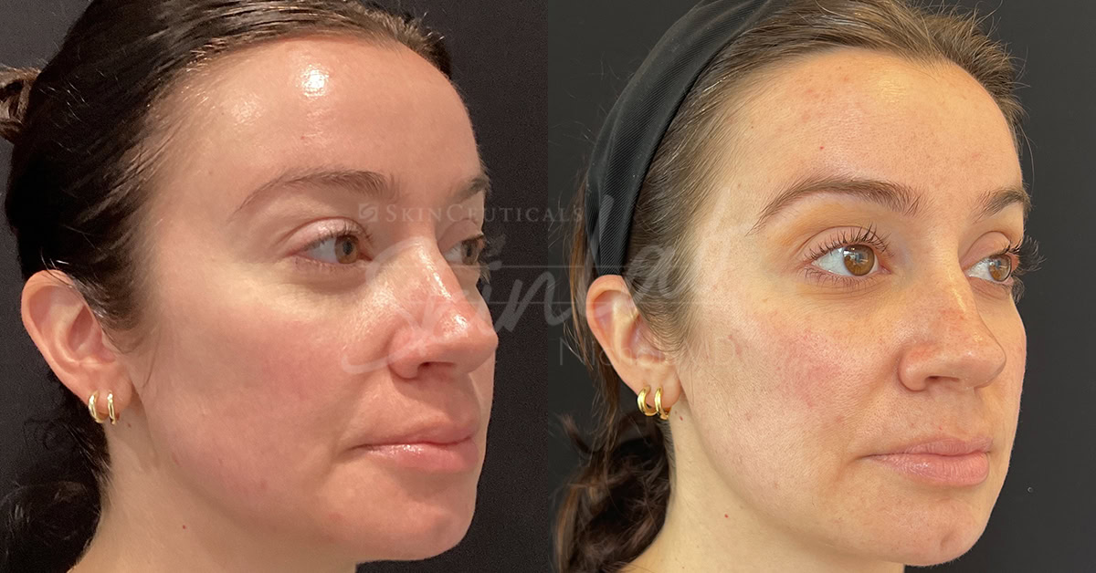 Before & After - Procedure Photos | SkinLab